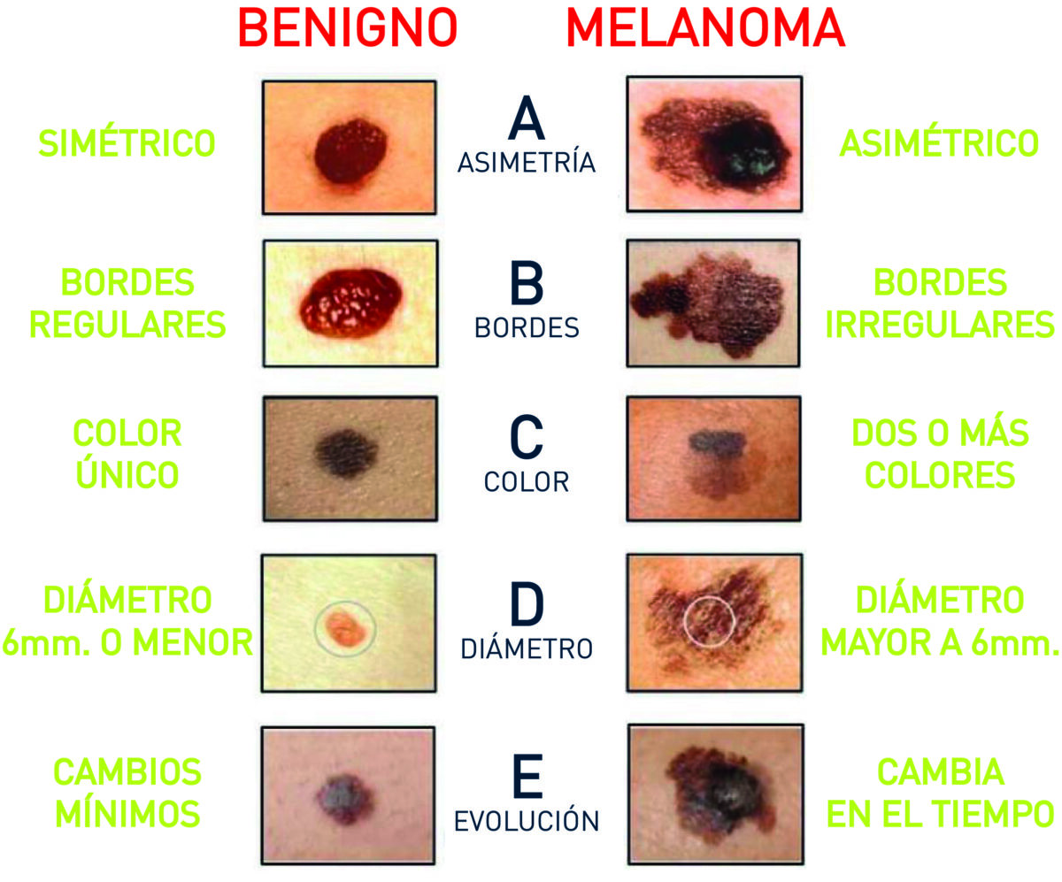 Día Mundial del Melanoma - Diagnóstico por Imágenes